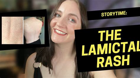 Lamictal Rash