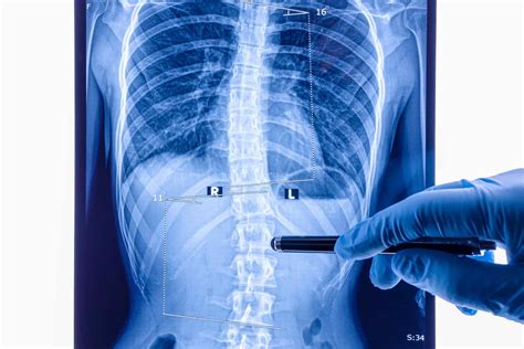 Micro Lumbar Discectomy In Turkey Check 2026 Cost And Prices