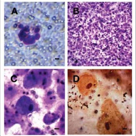 Circulating Tumour Cells Ctcs Isloated From A Patient P1 With