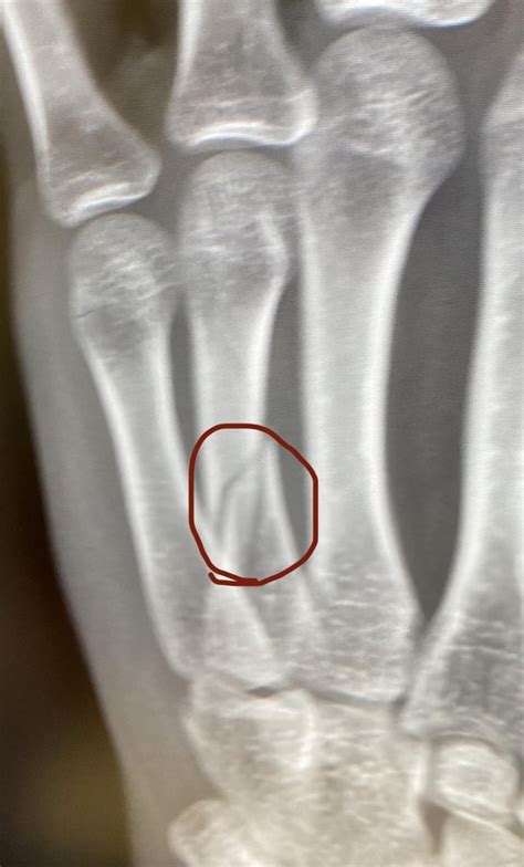 4th Metacarpal How Bad Is It R Brokenbones