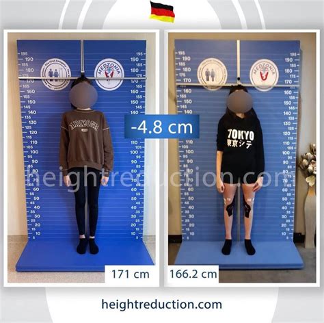 What Is Height Reduction Surgery A Detailed Guide