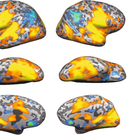 A Ffx Glm Group Activation Map For The Inner Speech Runs Qfdr