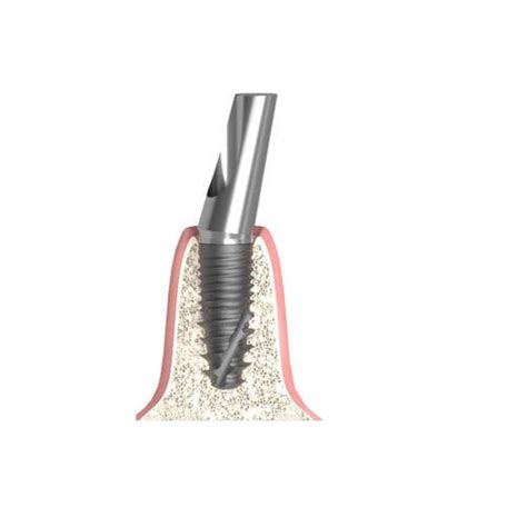 Cylindro Conical Implant Abutment Actival Bionika Medline Kft