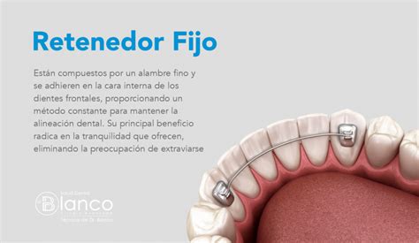 Retenedores Dentales Tipos Cuánto Tiempo Usarlos Y Cuidados