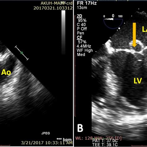 Systolic Anterior Motion Of The Mitral Valve As Seen By Download