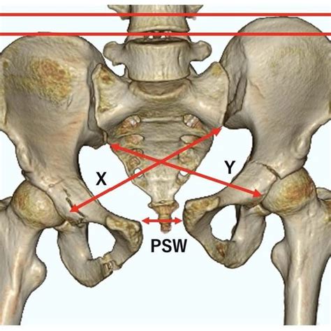 Minimally Invasive Surgical Spinopelvic Fixation Mis‐spf Technique