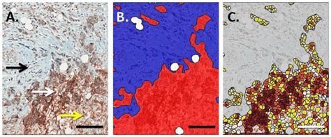Immunohistochemical Staining Of Caix Is An Important Tool To