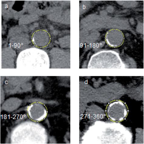 Cross Sectional View Of Abdominal Aortic Calcification By Ct In Four Download Scientific