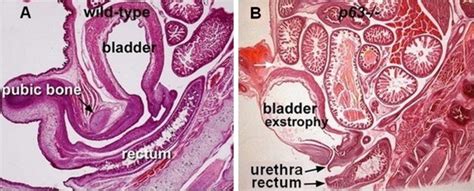 New Insights Into The Pathogenesis Of Bladder Exstrophyepispadias