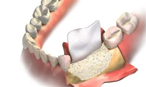 How Long Does Guided Bone Regeneration Gbr Take A Comprehensive Guide Dentalmaster Dental