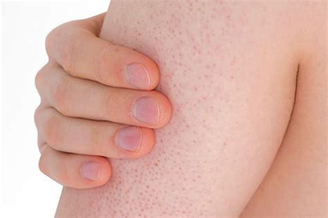 Dry Bumpy Rash