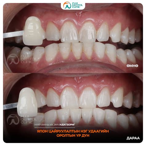Fuji 🦷Япон цайруулалтын нэг удаагийн үр дүн 👨‍⚕️Нүүр амны их эмч Н Батзориг 🌟Та Fuji Clinic т