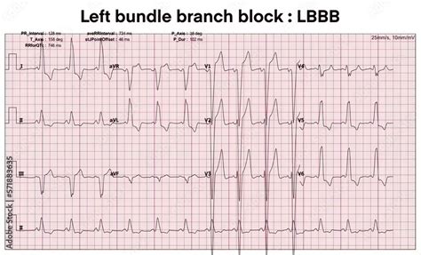 Electrocardiogram Show Left Bundle Branch Block Lbbbheart Beat Cpr