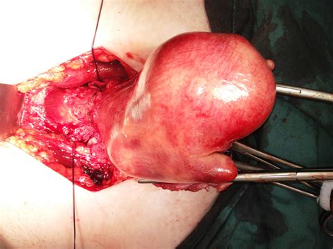 Uterine Artery Embolization Complication Dr Serag Youssif