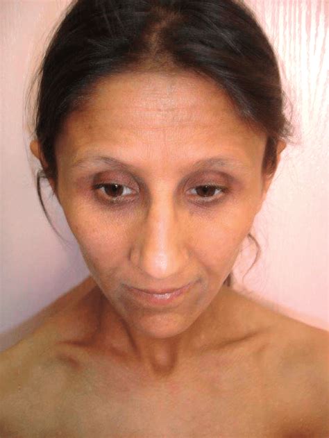 The Appearance Of Milimetric Hyper And Hypopigmented Macules On Both Download Scientific