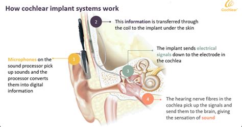 Cochlear Asic Fpga Development At Cochlear Technology Center Mechelen Verotech