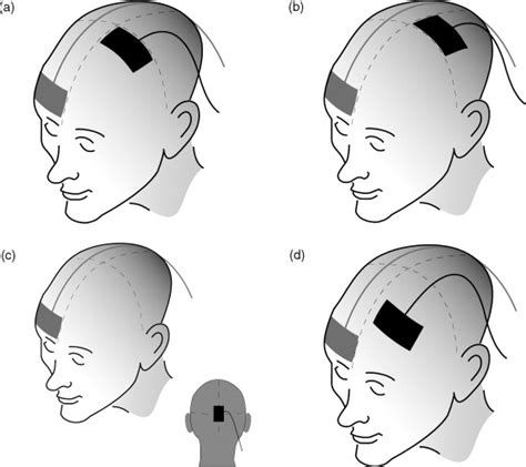 Tdcs Transcranial Direct Current Tdcs Electrode Positioning