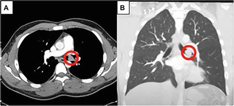 Robot Assisted Left Lower Sleeve Lobectomy For Mucoepidermoid Carcinoma Annals Of Thoracic