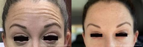 Botox® Cosmetic Before And After Gallery