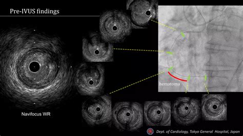 Successful Pci For Rca Cto With Knuckle Wire Technique And Reverse Cart