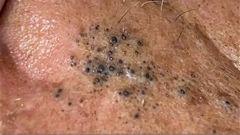 Try Again Black Head Removal Youtube