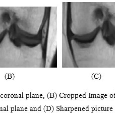 Watershed Algorithm And Adaptive Threshold Canny Edge Detection Based Automatic Segmentation Of