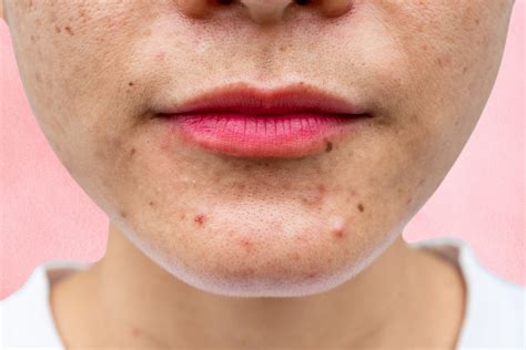 Do Band Aids Really Get Rid Of Acne And Pimples