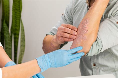 Psoriazis Sedef Hastalığı Araştırma Hastanesi