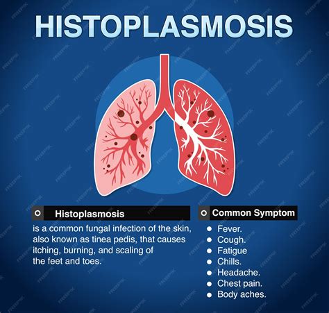 Premium Vector Informative Poster Of Histoplasmosis