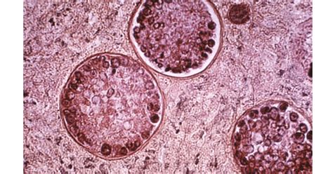 Coccidioides Immitis