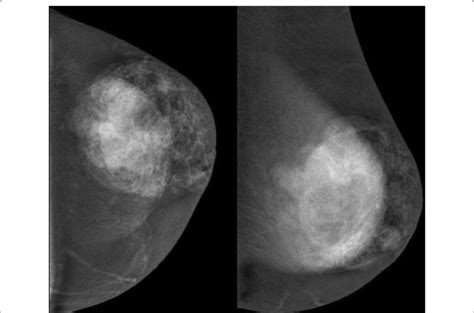 Contrast Enhanced Spectral Mammograms Of The Left Breast In A Download Scientific Diagram