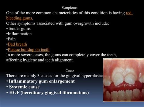 Pulp Polyp And Gingival Polyp PPTX