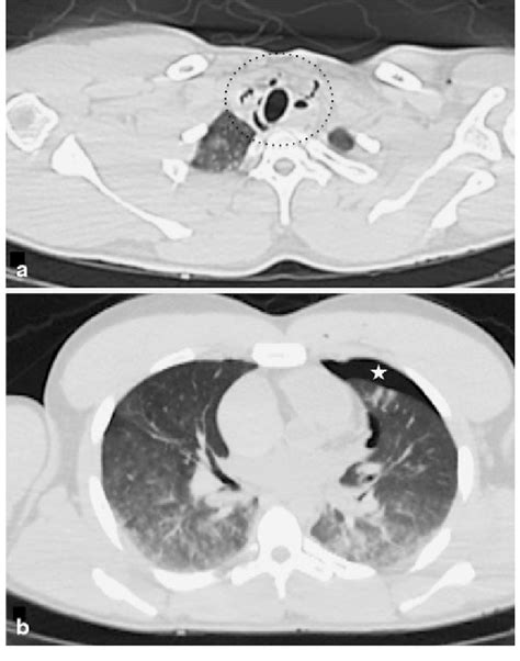 Postmortem Computed Tomography A Axial Plane In The Pulmonary Window Download Scientific