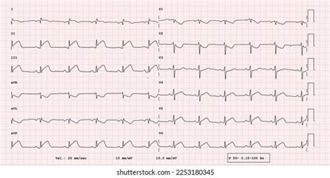 Ecg Example 12 Lead Rhythm Acute Myocardial Stock Illustration 2253180345 Shutterstock