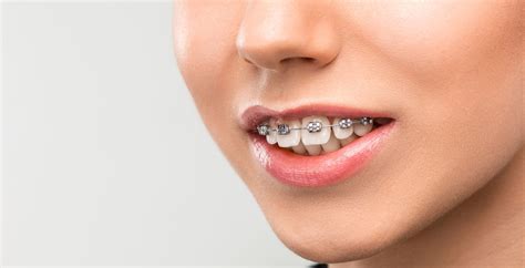 Underbite Vs Overbite Whats The Difference