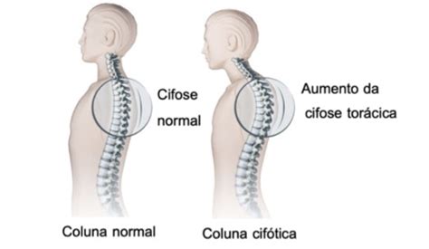 Cifose ou corcunda na coluna - Dr. Alberto Gotfryd