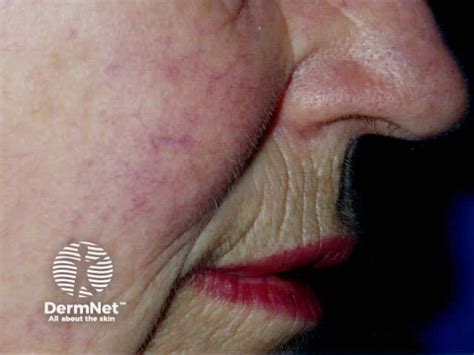 Dermnet Rosacea Rhinophyma Is A Skin Condition Affecting The Nose In