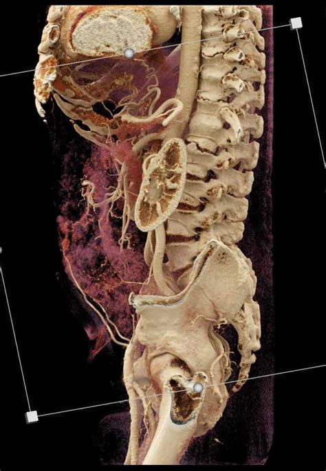 Gastric Gist Tumor Stomach Radiology Case Studies Ctisus Ct Scanning Gastric Gist Tumor Stomach Radiology Case Studies Ctisus Ct Scanning