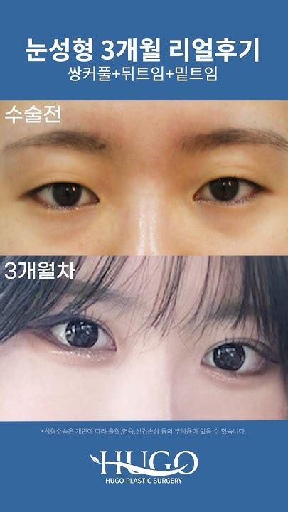 눈성형 전후 비교 쌍수 앞트임 뒤트임 밑트임 3개월 리얼 후기 Youtube