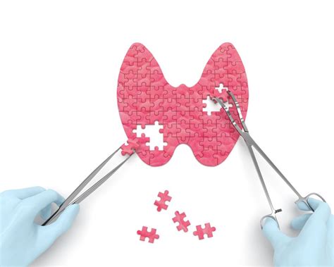 Treatments For Hyperthyroidism ActiveBeat