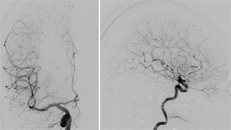 Temporal Avm Embolization Via Double Access