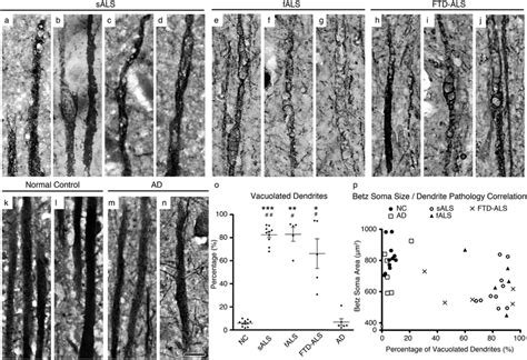 Apical Dendrites Are Filled With Vacuoles And Disintegrate Only In Als