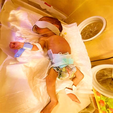 Newborn Jaundice Detection Object Detection Model By Machine Image Processing