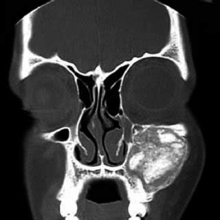 Circumscribed Radiopacity In The Left Sinus Region Download