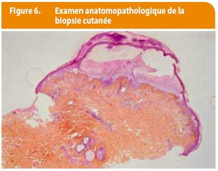 Épidermolyses Bulleuses Héréditaires Ddvlne