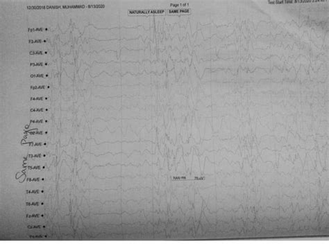 Abnormal EEG Patterns PPTX Brain And Nervous System Disorders Diseases And Conditions