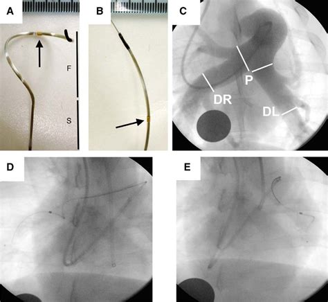 Pulmonary Artery Denervation Pdn Catheter And Procedure Prototype Download Scientific