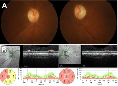 A Fundus Photo Showing Bilateral Eye Optic Atrophy B Oct Download Scientific Diagram