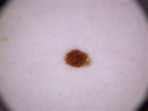 Not · Issue 4 · Yasmine01545skin Cancer Diseases Classification Using