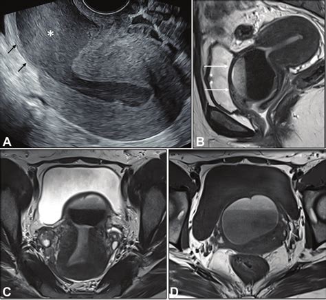 Transvaginal Ultrasound Image A Shows A Retroflexed Uterus With